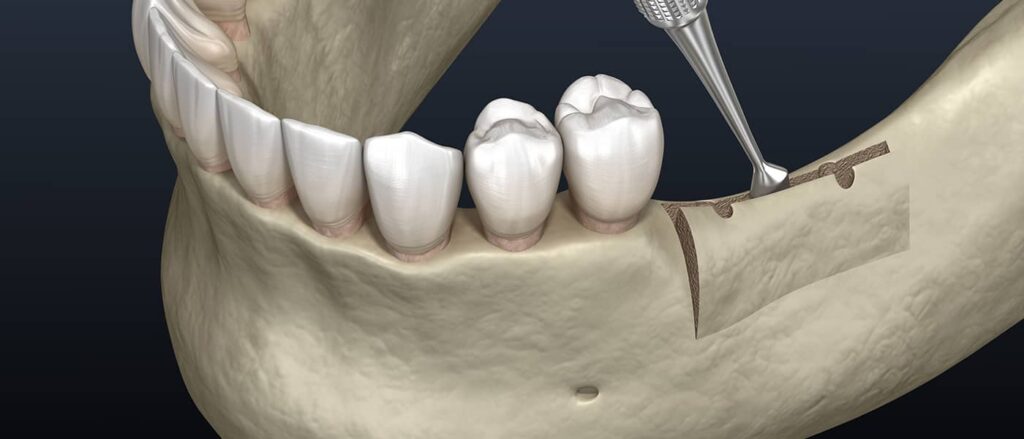 Ridge Augmentation | Oral Surgeon Highlands Ranch | Highlands Ranch Perio