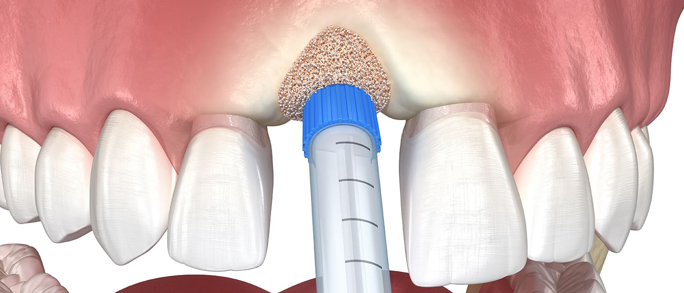 Socket preservation | Alveolar Ridge Preservation | Highlands Ranch ...